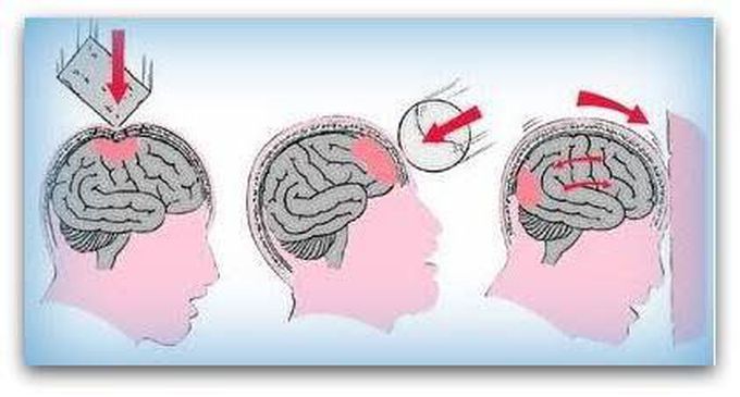 Treatment of cerebral contusion - MEDizzy