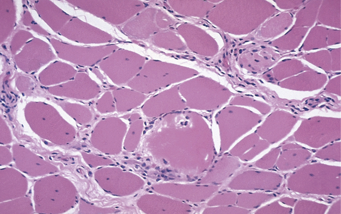 A 5-year-old boy develops increasing muscle weakness. He is - MEDizzy