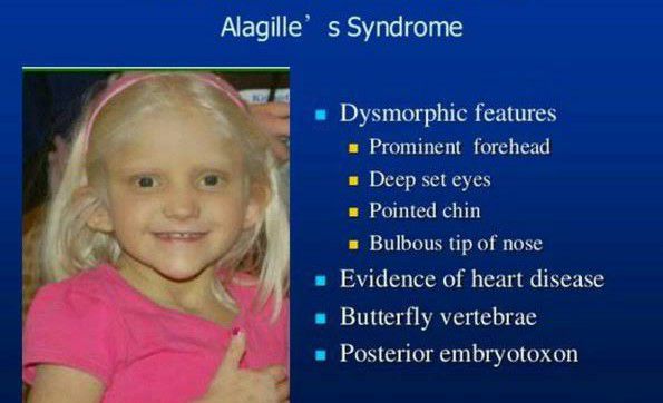 These are the features of Allagille's syndrome - MEDizzy