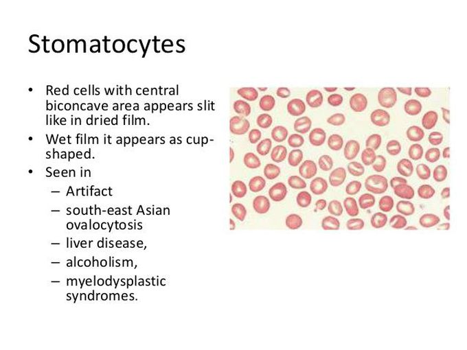 Stomatocyte - MEDizzy