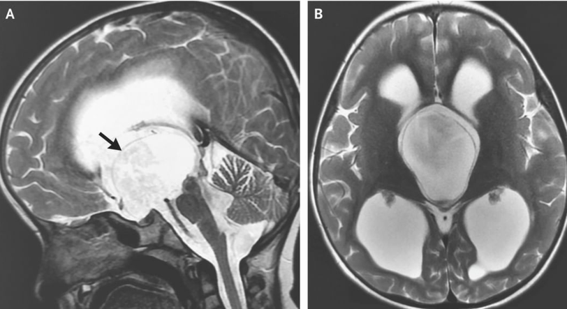 Bobblehead-Doll Syndrome. - MEDizzy