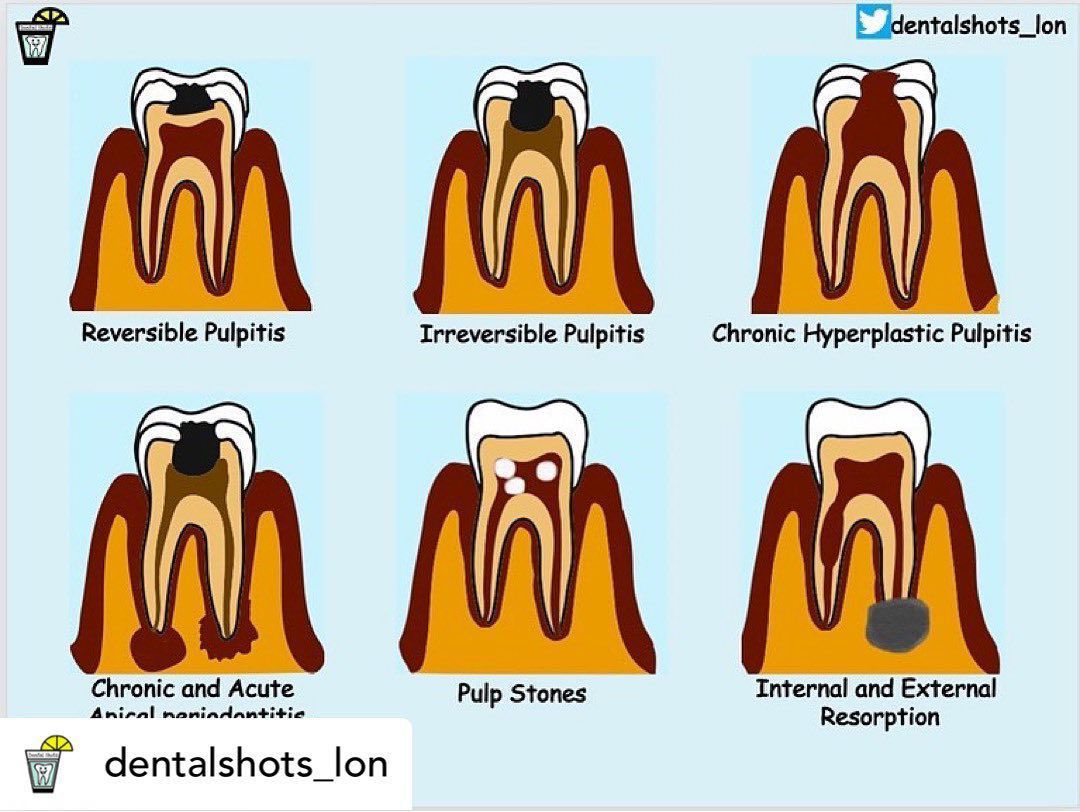 chronic hyperplastic pulpitis