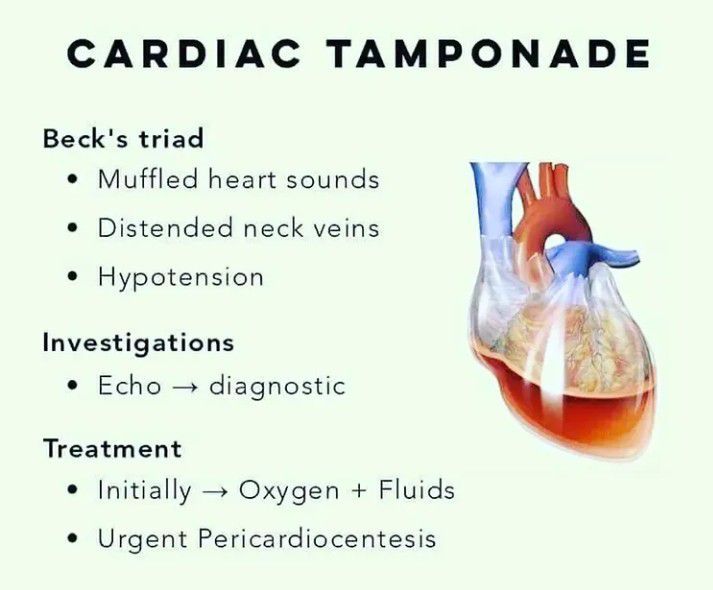 Cardiac temponade - MEDizzy