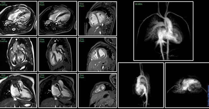 Advanced MRI Cardiac Imaging w/GADOVIST @ Siemens 1.5T Aera - MEDizzy