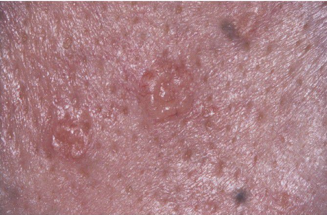 Sebaceous Hyperplasia - MEDizzy