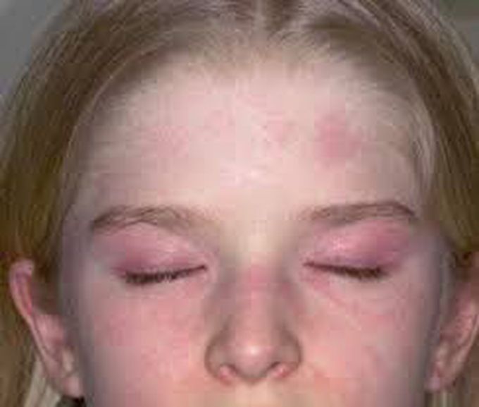 Juvenille dermatomyositis - MEDizzy