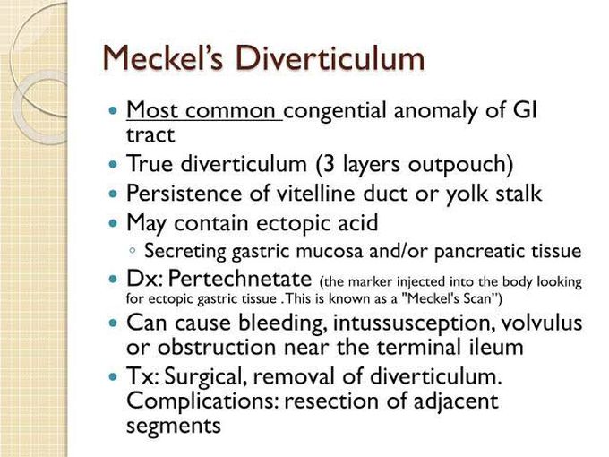 Meckel's Diverticulum - MEDizzy