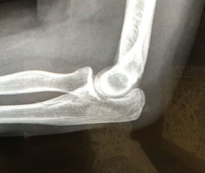 Case study :Gradually worsening elbow pain - MEDizzy