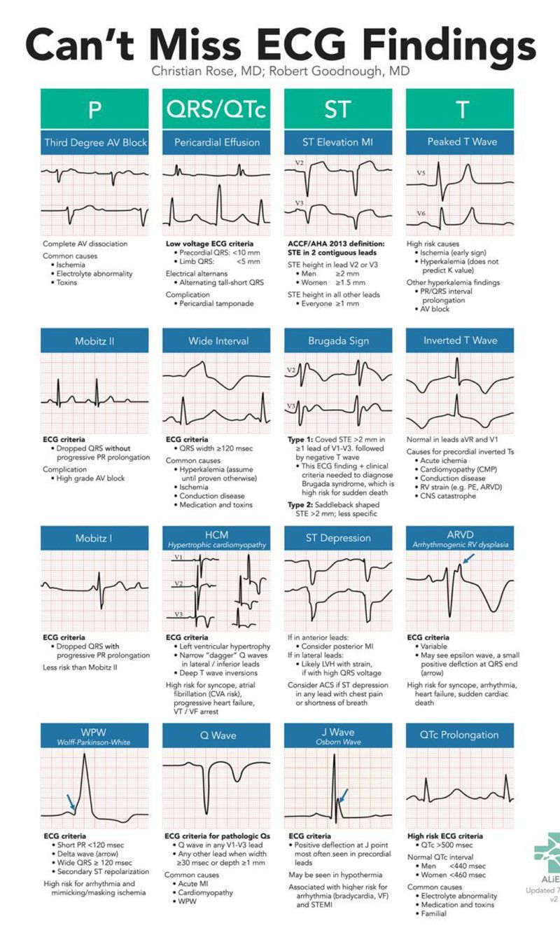 EKG findings - MEDizzy