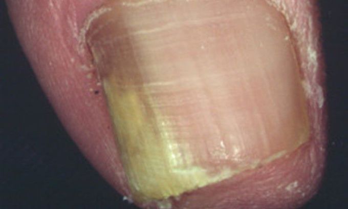 Fungal nail infection - MEDizzy