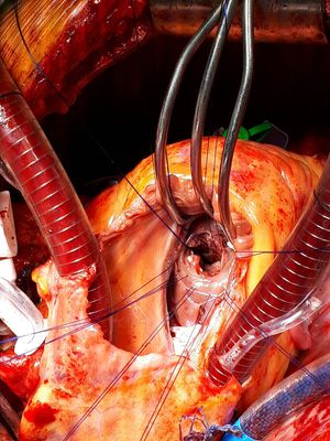 Rupture VSD - MEDizzy