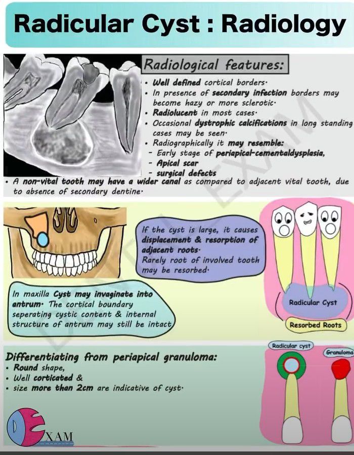 Radicular cyst - MEDizzy