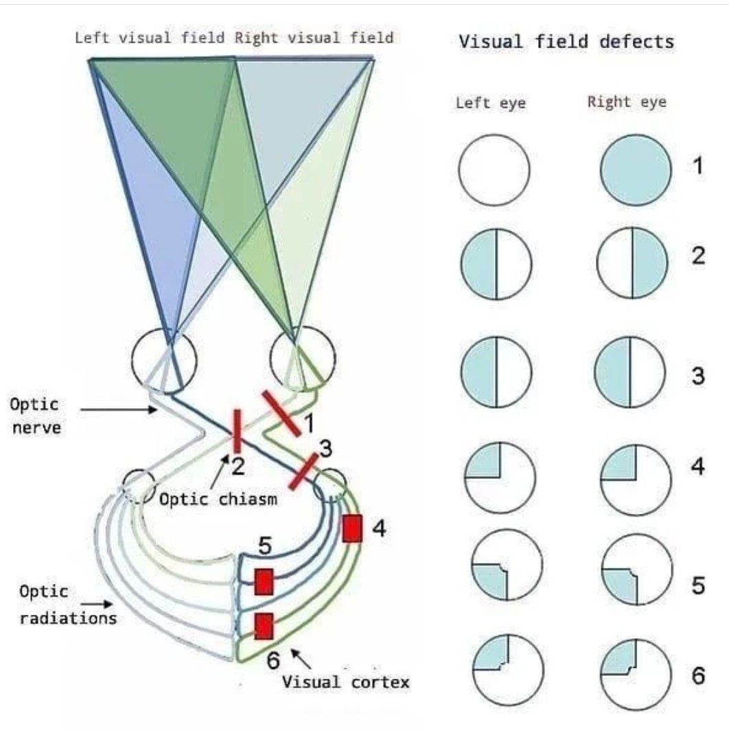 The Visual Field MEDizzy