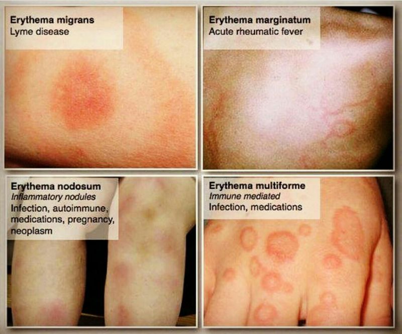 Erythema Marginatum Vs Erythema Migrans NTE®N🅰L Ⓜedℹ©ℹne