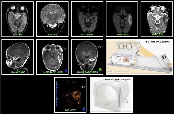 LMT MRI incubator @ Siemens 3T Skyra. Great for newborn - MEDizzy
