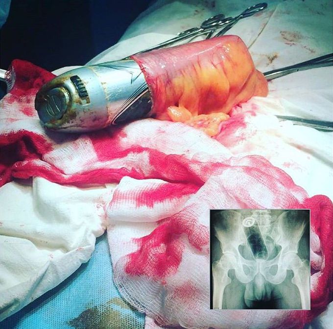 Foreign body: antiperspirant - MEDizzy