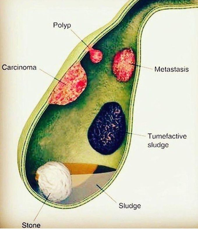 Biliary Diseases - MEDizzy