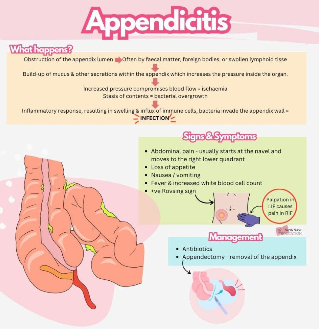 Appendicitis - MEDizzy