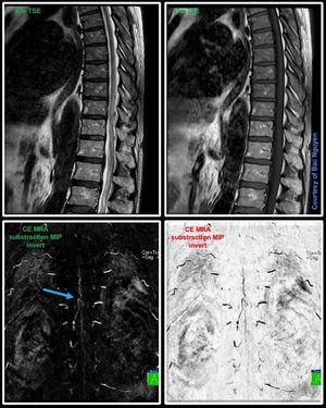 Spinal Arteriovenous Malformations @ Siemens 3T - MEDizzy