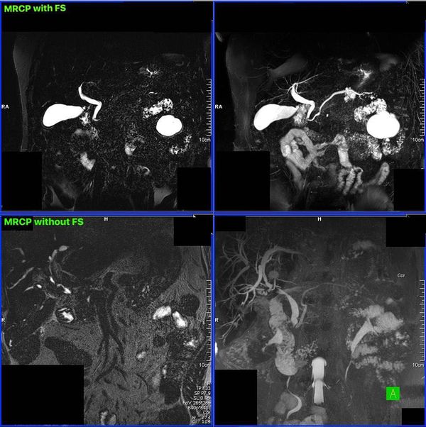 Magnetic resonance cholangiopancreatography (MRCP) is an MRI