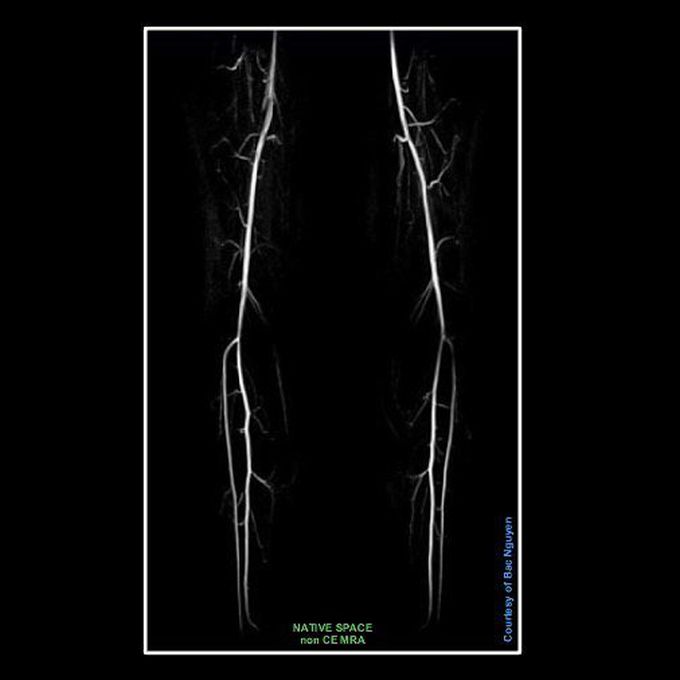 non Contrast Enhanced MR Angiography – Native SPACE @ - MEDizzy