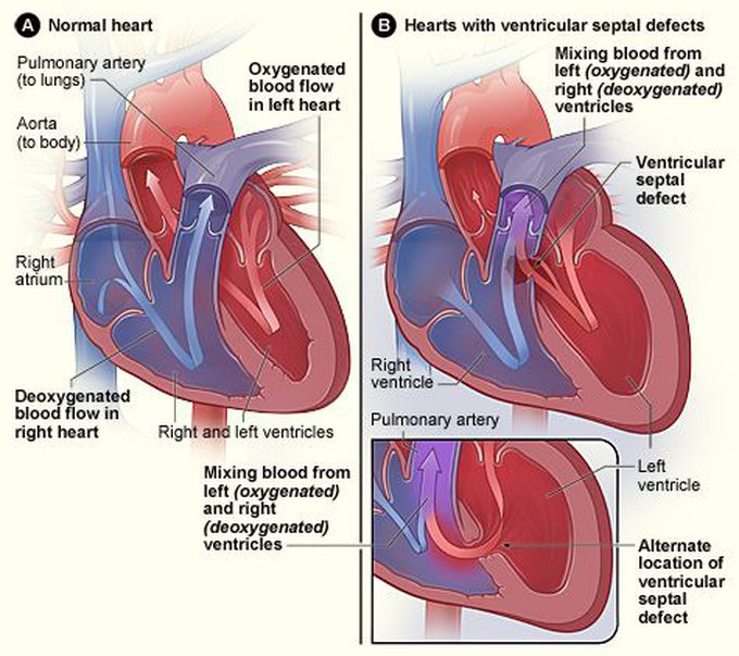Normal heart and ventricular septal defect - MEDizzy