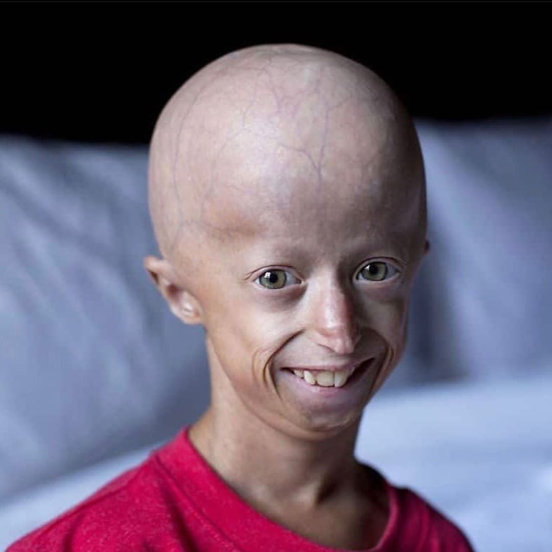 Sindrome De Progeria De Hutchinson Gilford YouTuber Adalia Rose Dead