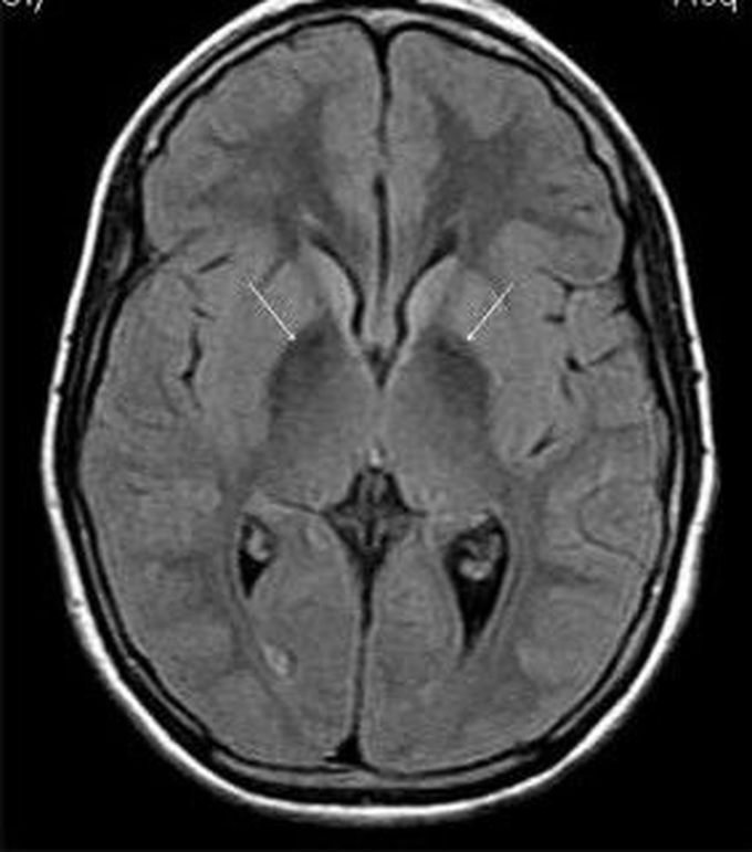 Aceruloplasminemia - MEDizzy
