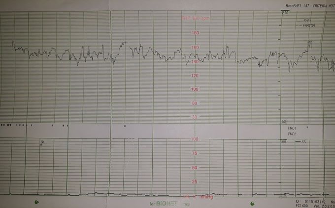 Normal NST - MEDizzy