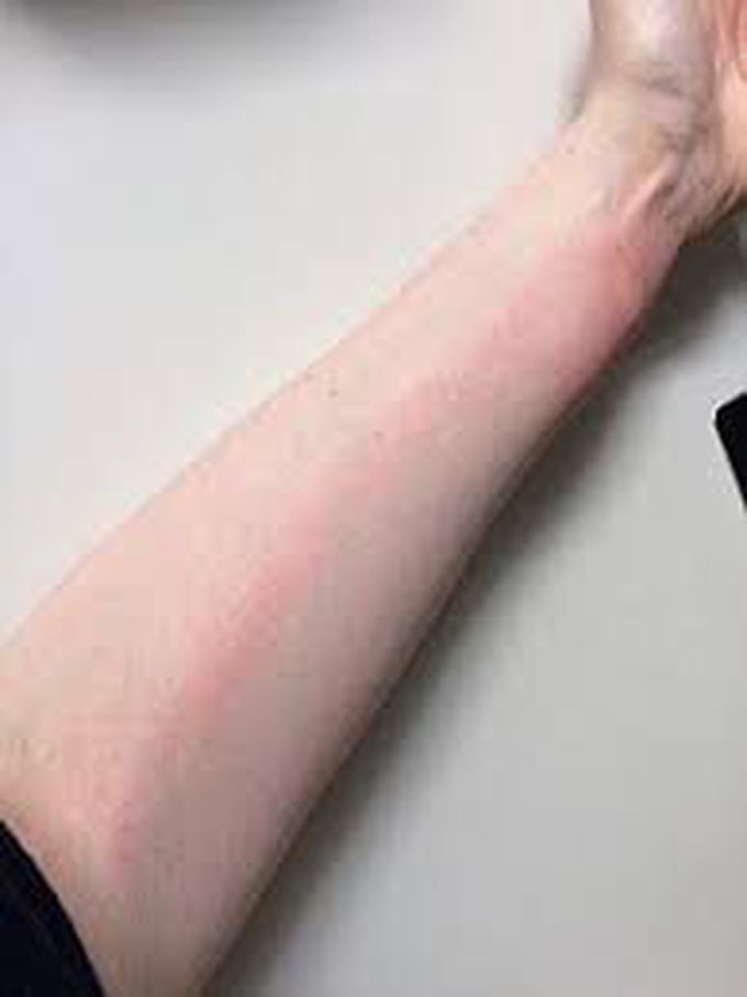 Lymphangitis - MEDizzy