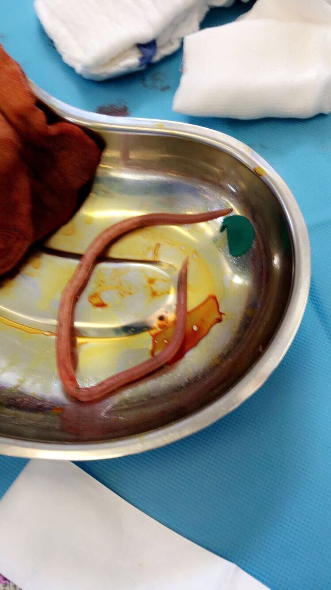 This patient was performed surgical operation of laparotomy - MEDizzy