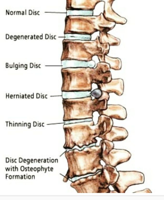 Disc problems - MEDizzy