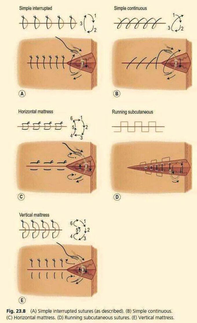 Types of suture - MEDizzy