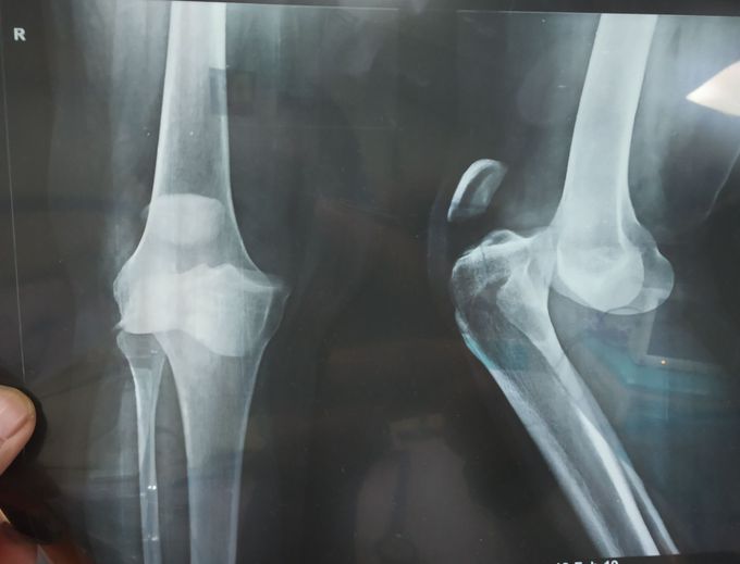 Tibial dislocation following rta ,ACL,PCL,MEDIAL AND LATERAL - MEDizzy