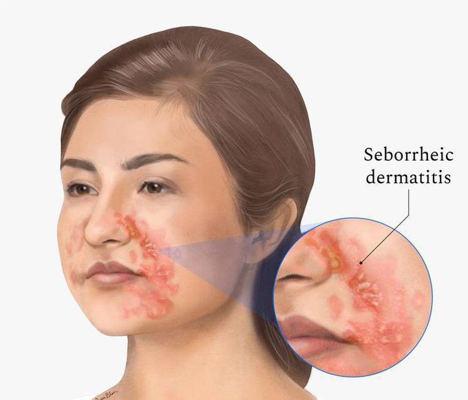Seborrheic dermatitis - MEDizzy