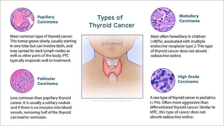 Types of thyroid cancer - MEDizzy