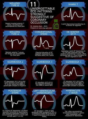 ECG PATTERNS STRONGLY SUGGESTIVE OF CORONARY OCCLUSION - MEDizzy