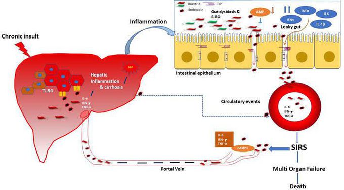 Bacterial Peritonitis - MEDizzy