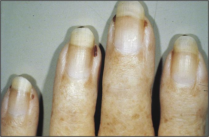 Nail Fold Infarcts. Full Article: Optimal Diagnosis And Management Of