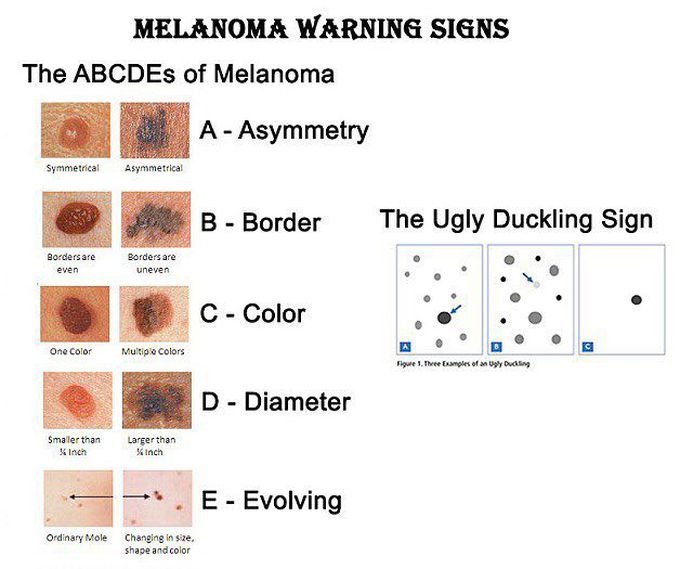 Melanoma Warning Signs - MEDizzy