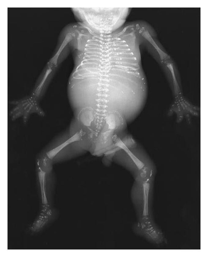 Chondrodysplasia Punctata - MEDizzy
