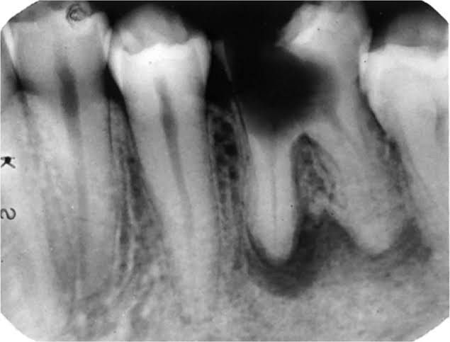 Periapical granuloma - MEDizzy