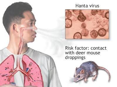 Hantavirus symptoms - MEDizzy
