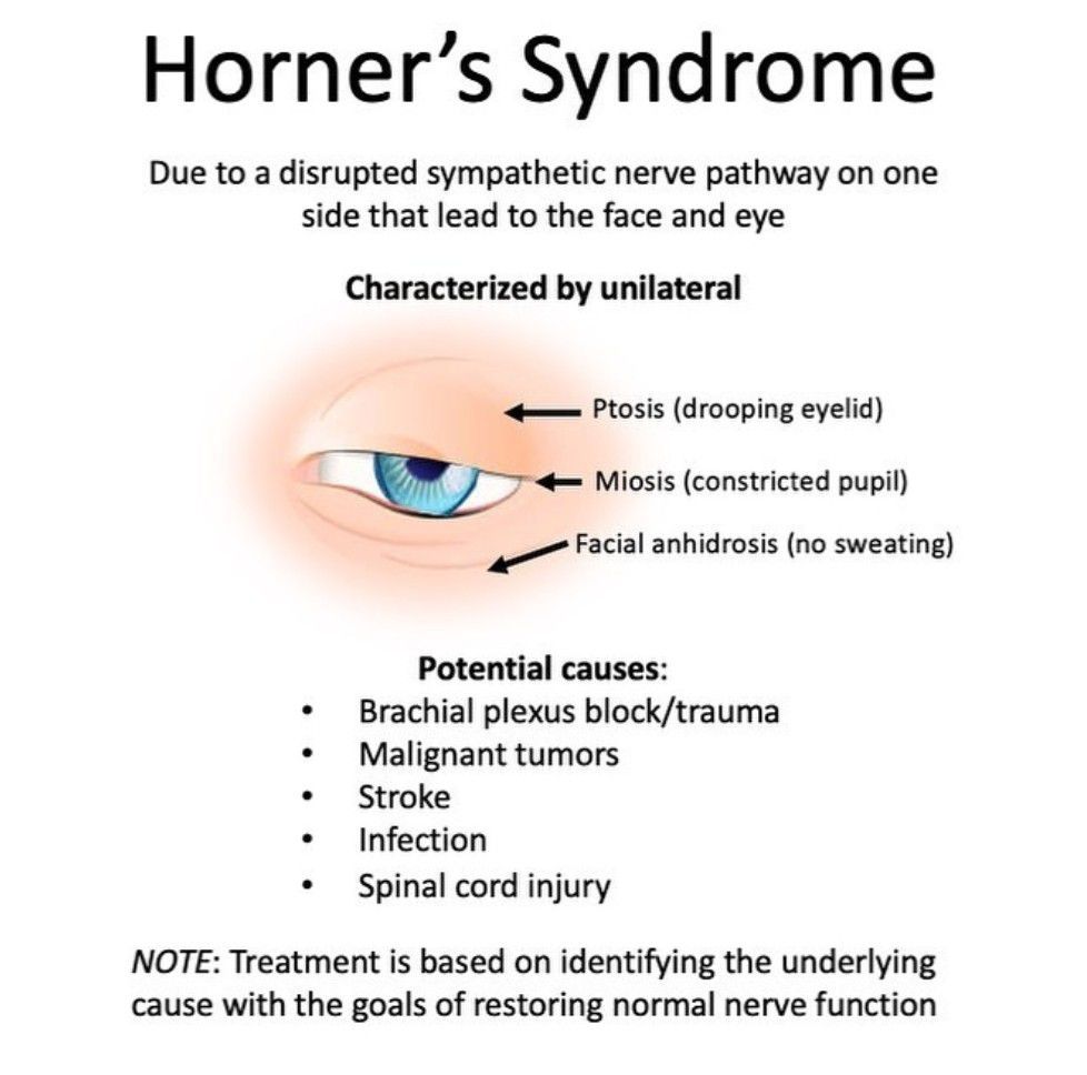 Horners Syndrome