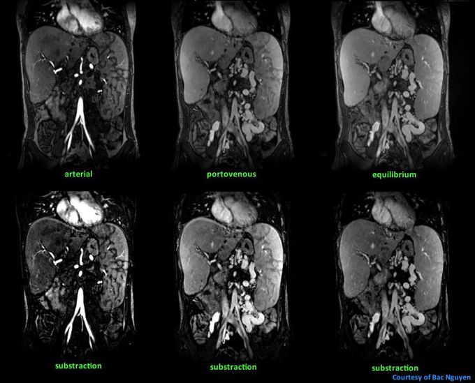 Portal systemic collateral pathways @ Siemens 3T Skyra - MEDizzy
