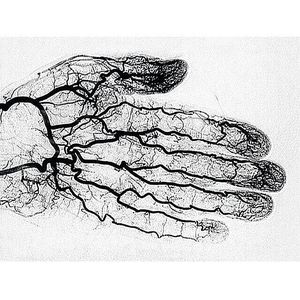 Angiography of hand vessels. #medical #medicine - MEDizzy