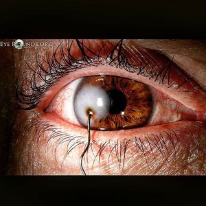 #penetrating #eye #trauma #ouch #whattodo #surgery #doctor - MEDizzy