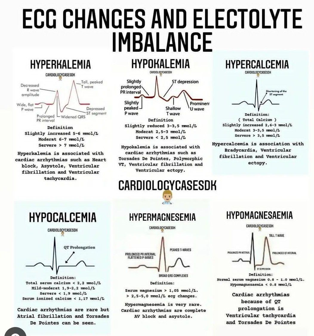 Ecg Changes MEDizzy