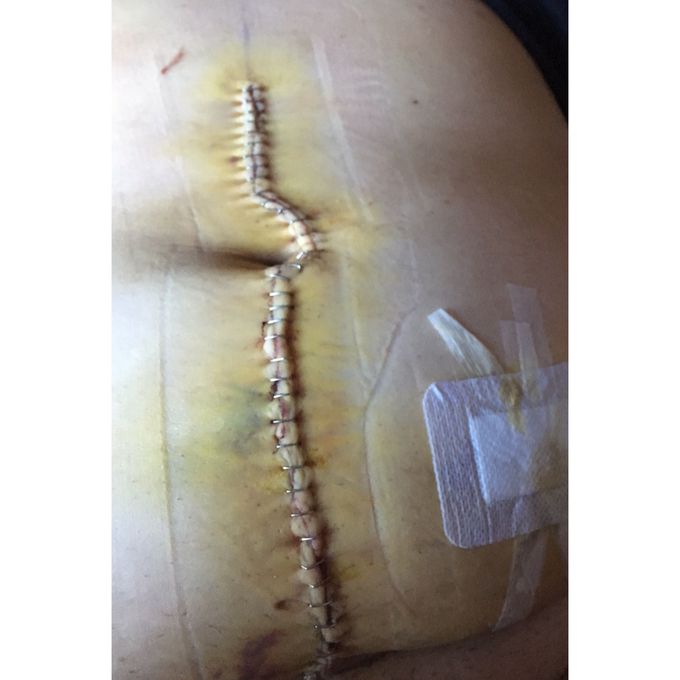 Suture 5 Days after an isterectomy - MEDizzy