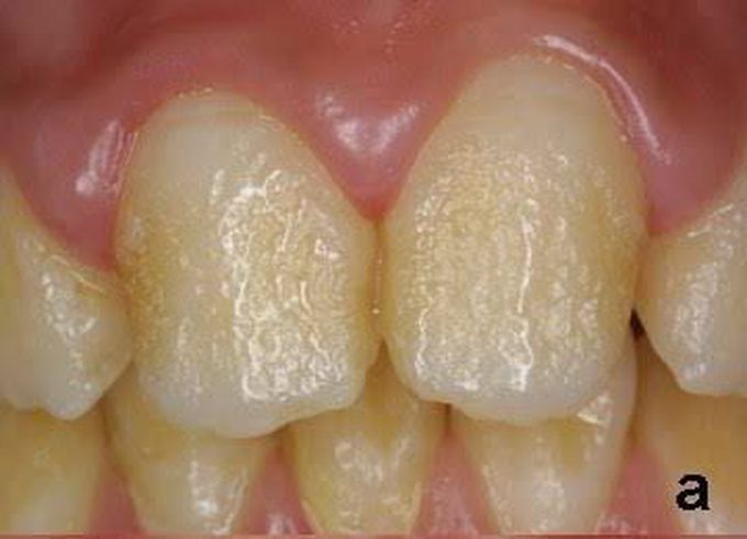 Pitted enamel - MEDizzy